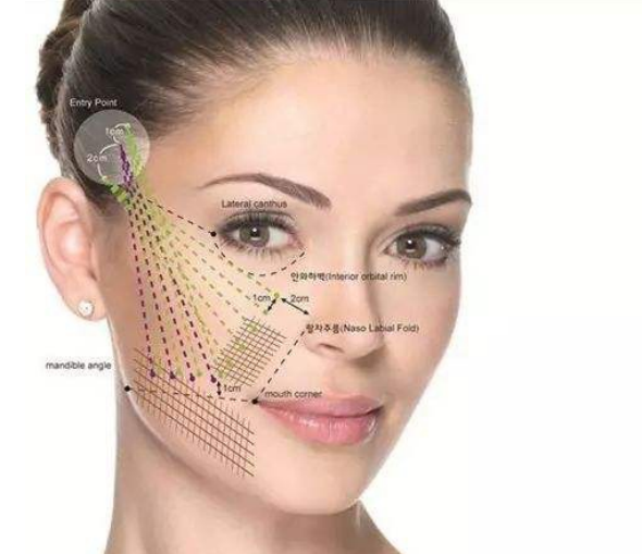 Advantages of PDO Lifting