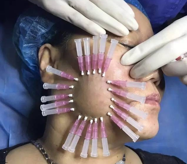 Advantages of PDO Lifting