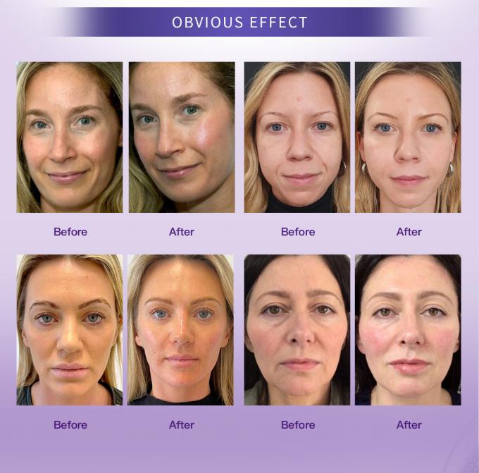 New Upgrade 1ml anti-wrinkle hyaluronic acid dermal lip filler injection