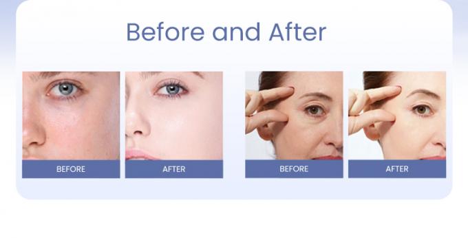 non cross linked hyaluronate promote skin regeneration hydro pdrn ...